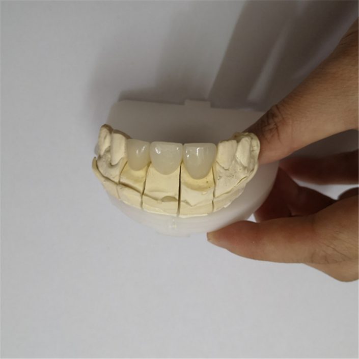 All-Ceramics – Shenzhen Well Dental Laboratory