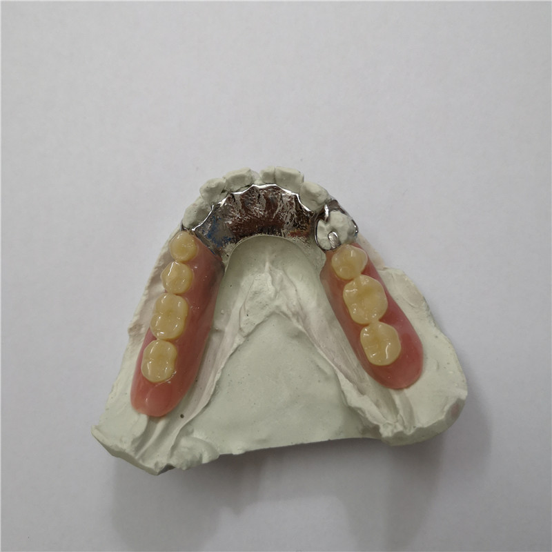 Metal Framework – Shenzhen Well Dental Laboratory